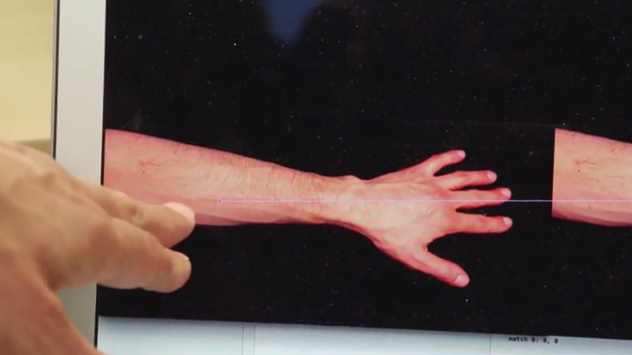 Mapping The Mole To Help Stop Skin Cancer