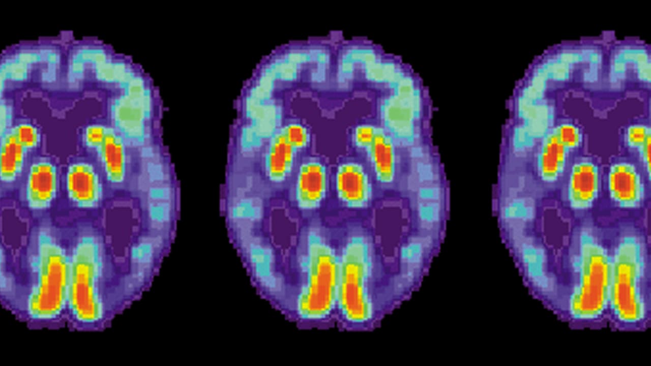 Artificial intelligence can detect Alzheimer's in brain scans six year Artificial intelligence can detect Alzheimer's in brain scans six year